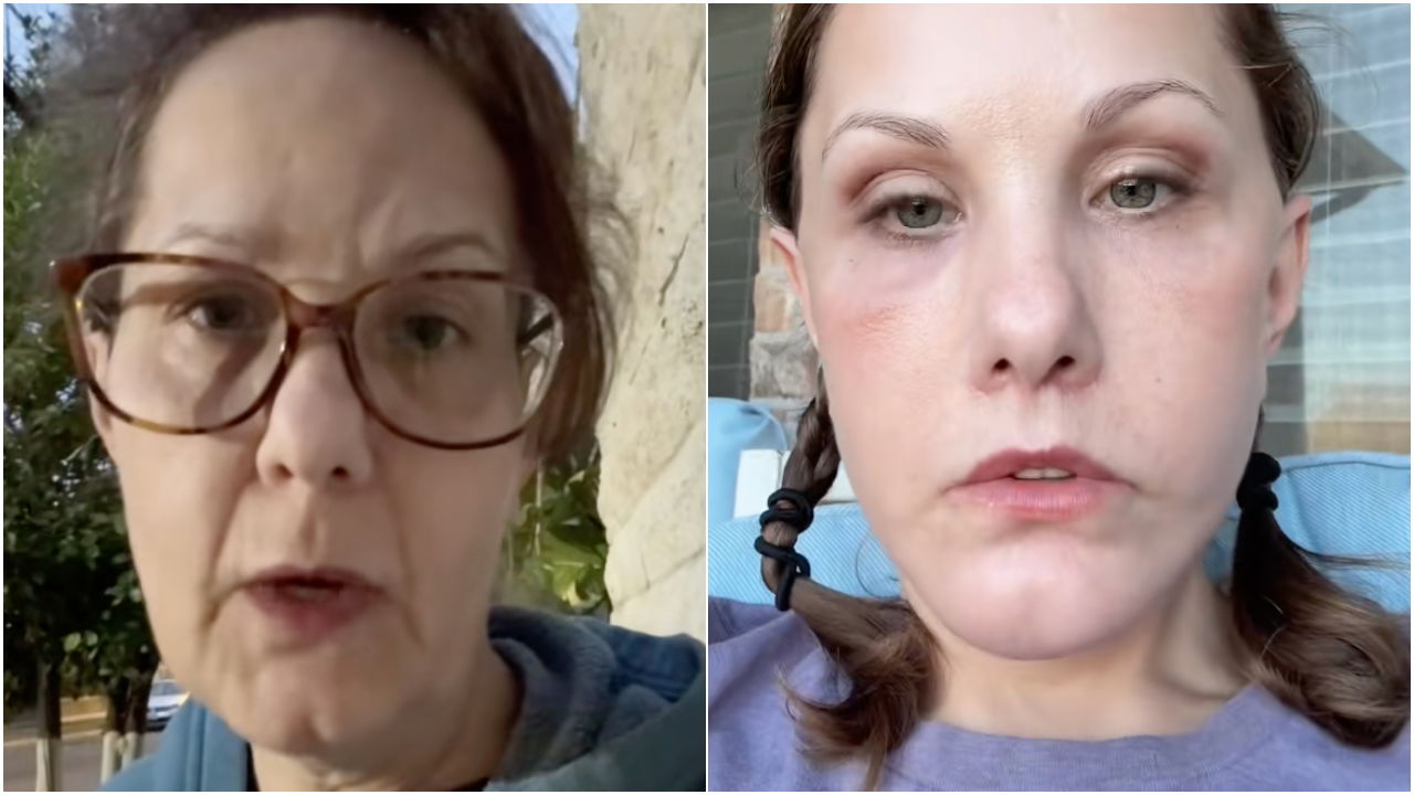 TikTok in de ban van "de beste facelift ooit" - Newsmonkey